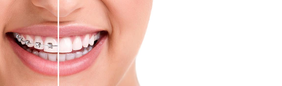 In-Ovation Before & After - Renton WA | Lasley Orthodontics