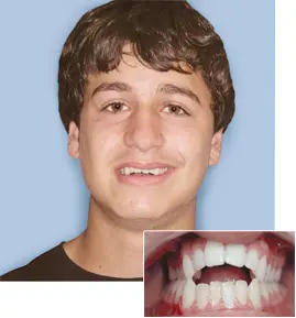 In-Ovation Braces in Renton, WA - Lasley Orthodontics