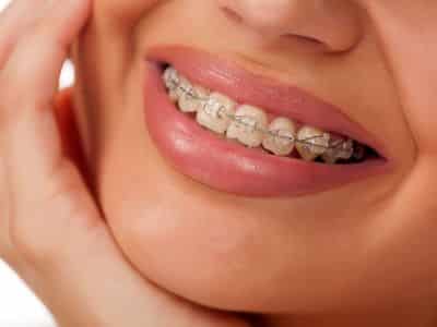 Life After Braces: Maintaining Your Beautiful Smile