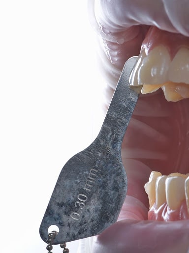 Orthodontic Spacers at Lasley Orthodontics | Complete Guide